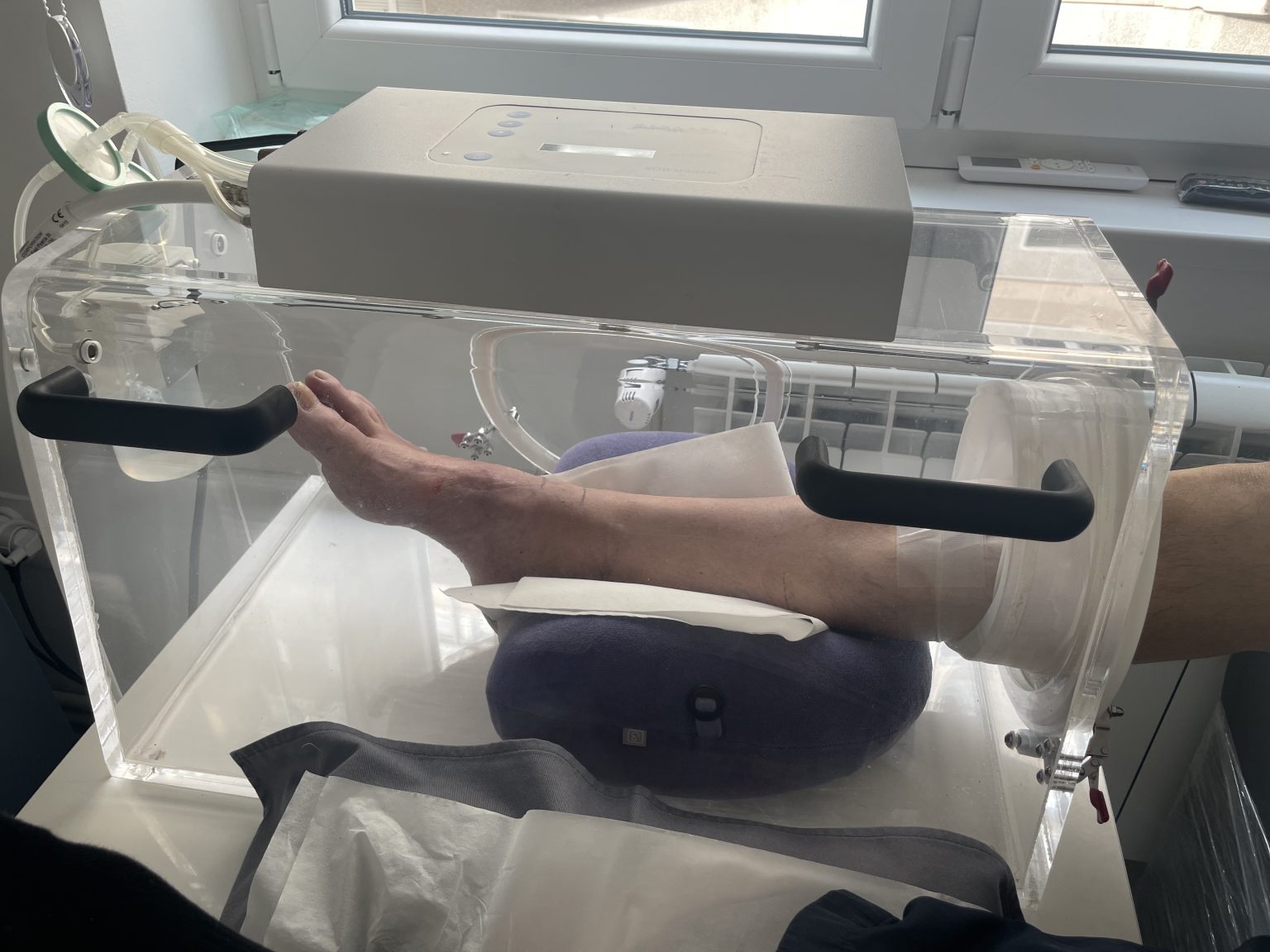 Dijabetsko ili dijabetesno stopalo - Simptomi, lečenje i prevencija ...